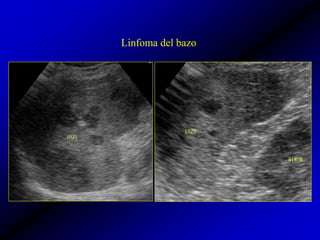 ecografia de bazo (esplenica) | PPT