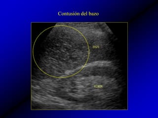 ecografia de bazo (esplenica) | PPT