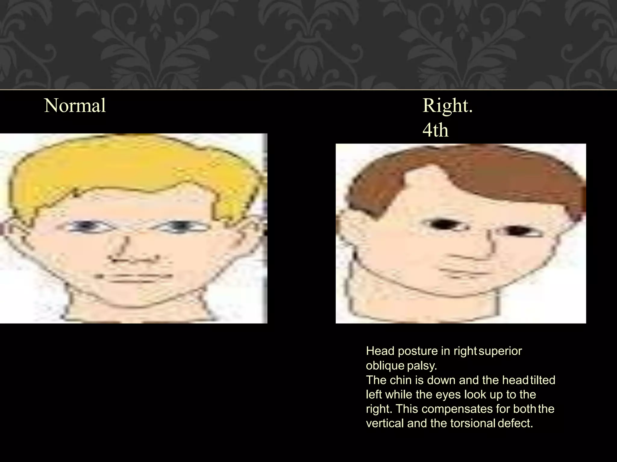 Diplopia | PPTX | Eye and Vision Conditions | Diseases and Conditions