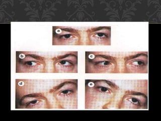Diplopia | PPTX