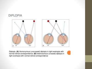 Diplopia - Ophthalmology ( quick revision ) | PPTX
