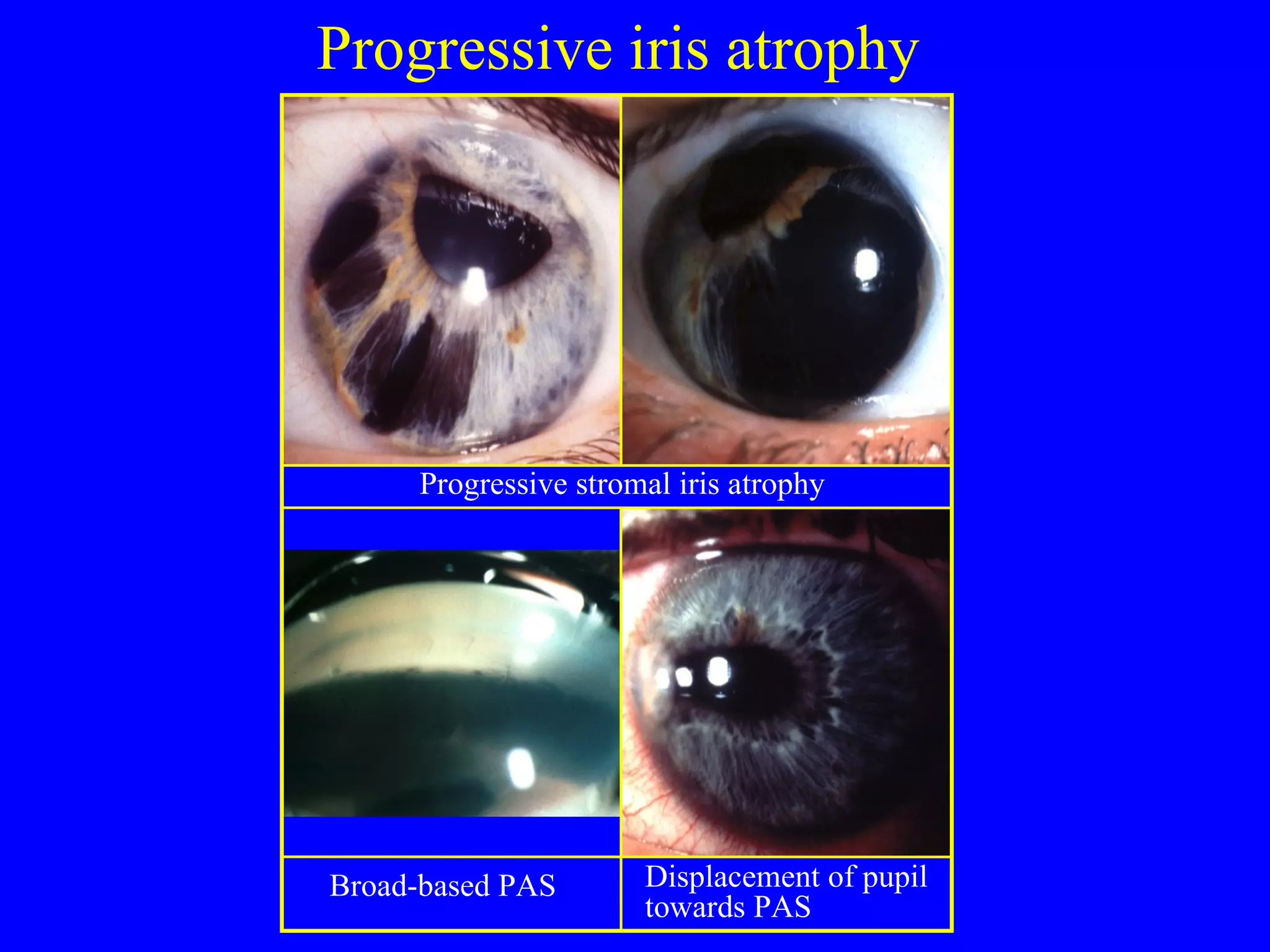 Diplopia strabismus ppt-talk_10-2010 | PPT