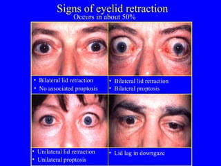Colliers Sign Eyelid Retraction