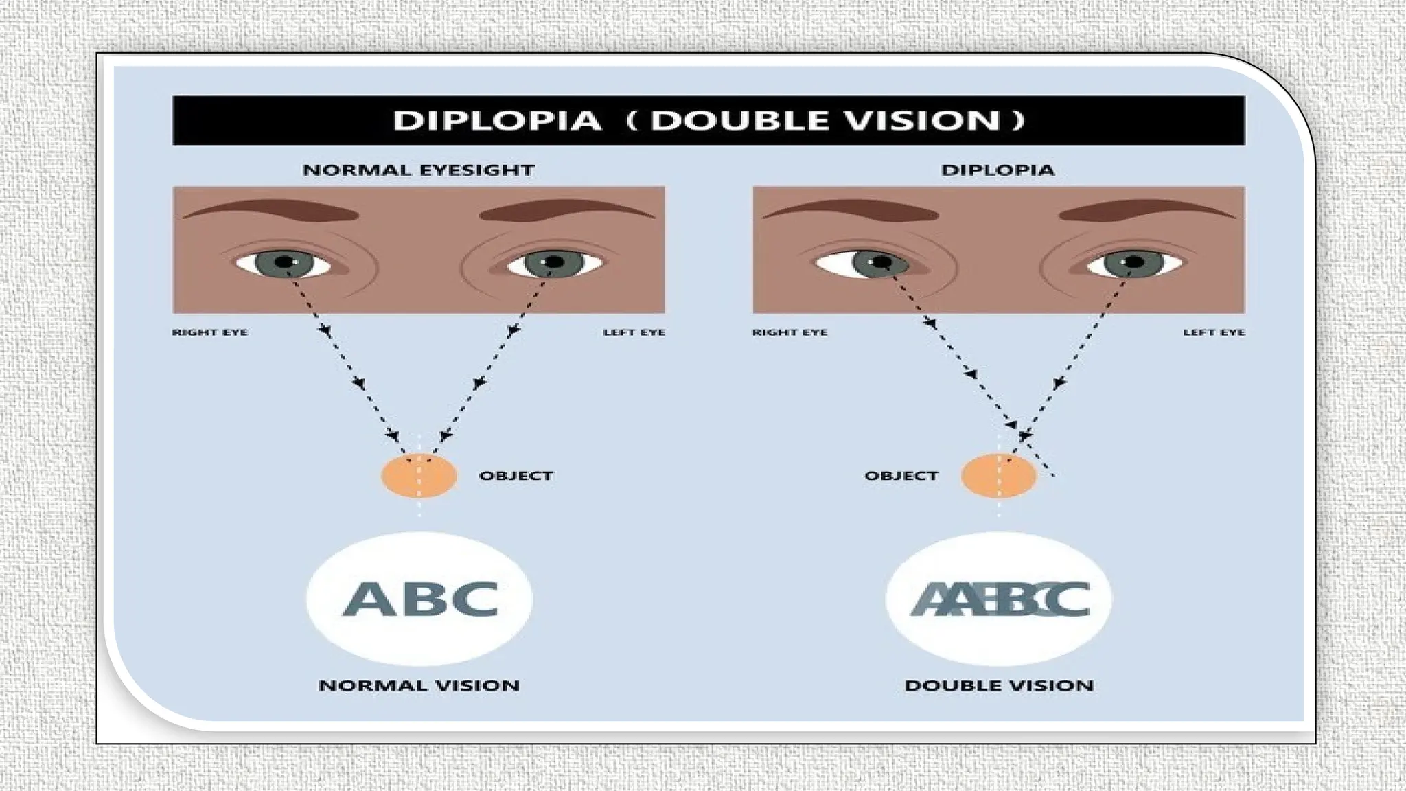 DIPLOPIA_98d3ffc0-f0d7-41b7-912c-3a3c23d72570.pptx