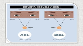 DIPLOPIA_98d3ffc0-f0d7-41b7-912c-3a3c23d72570.pptx