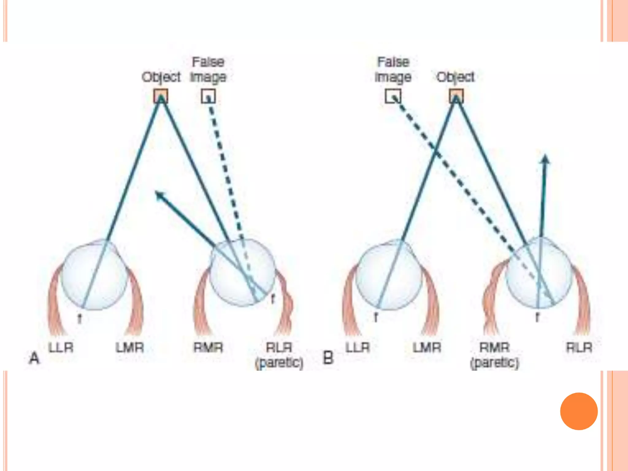 Diplopia approach | PPTX