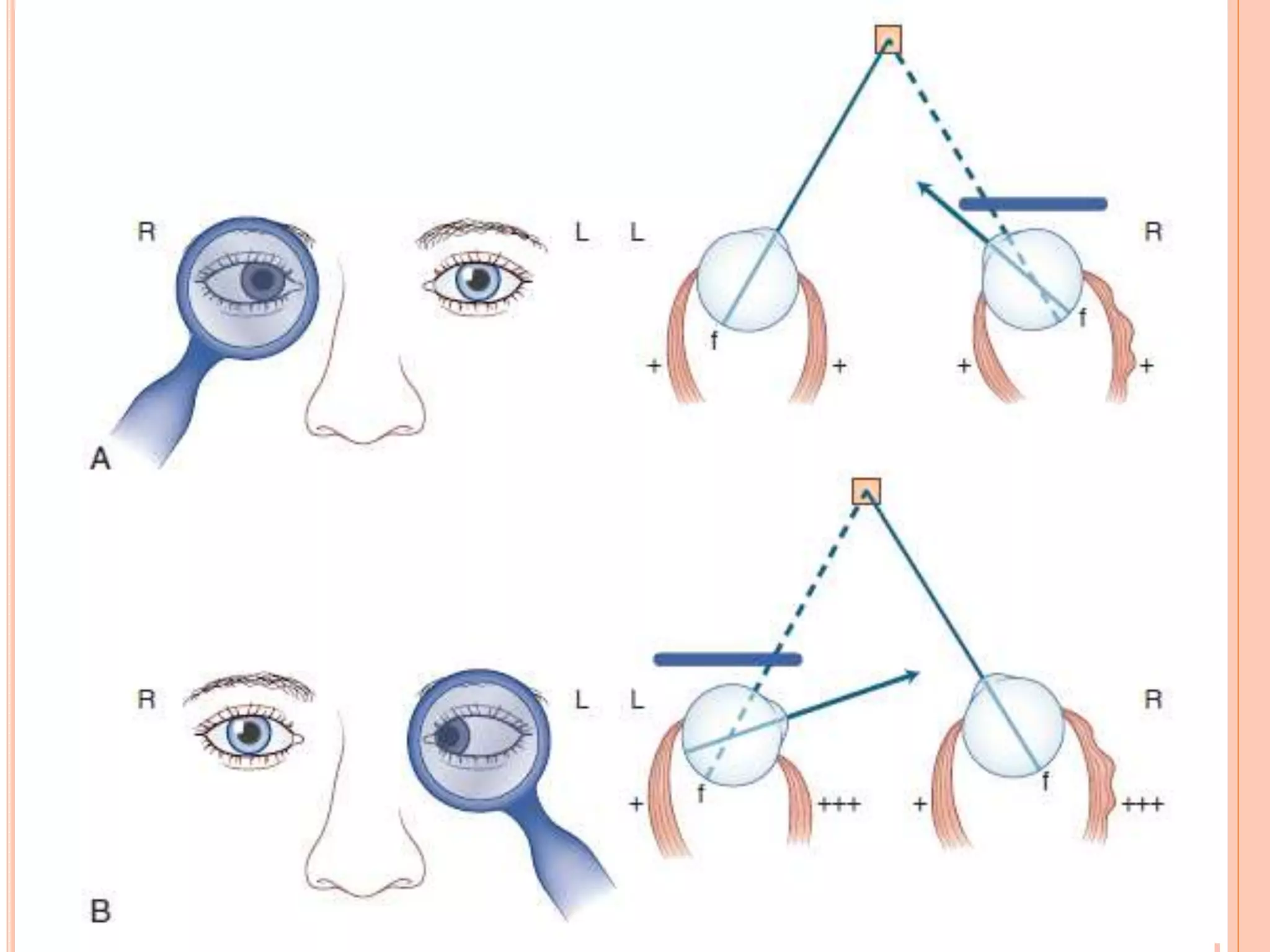 Diplopia approach | PPTX | Eye and Vision Conditions | Diseases and ...