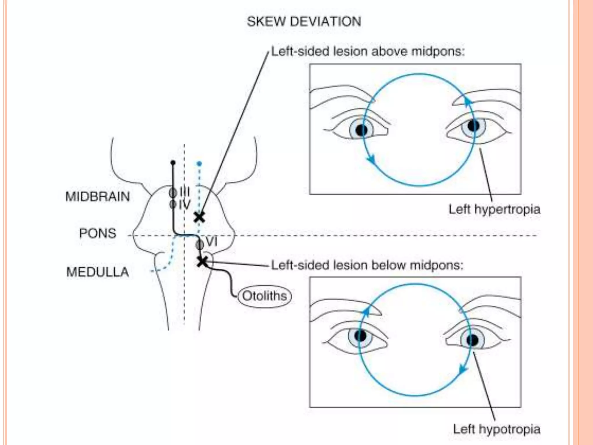 Diplopia approach | PPTX