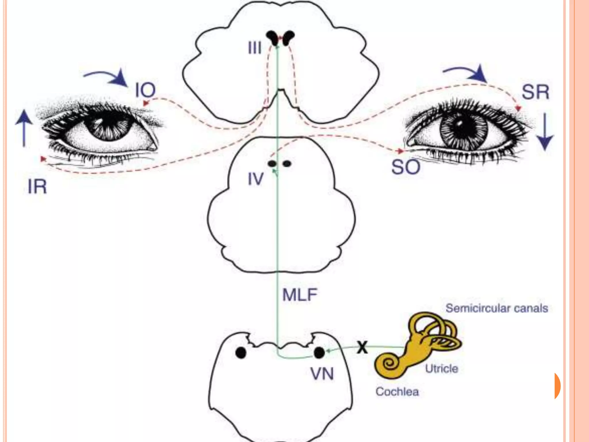 Diplopia approach | PPTX | Eye and Vision Conditions | Diseases and ...