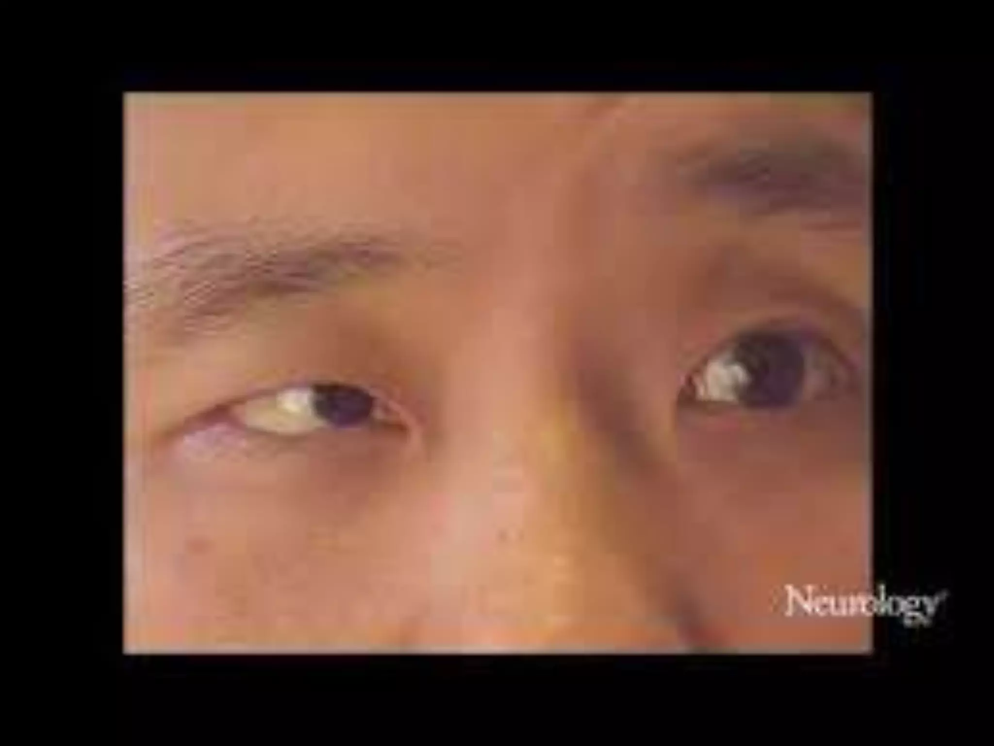 Diplopia approach | PPTX | Eye and Vision Conditions | Diseases and ...