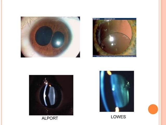 Diplopia approach | PPTX | Eye and Vision Conditions | Diseases and ...