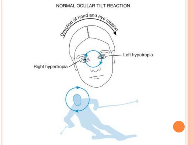 Diplopia approach | PPTX | Eye and Vision Conditions | Diseases and ...