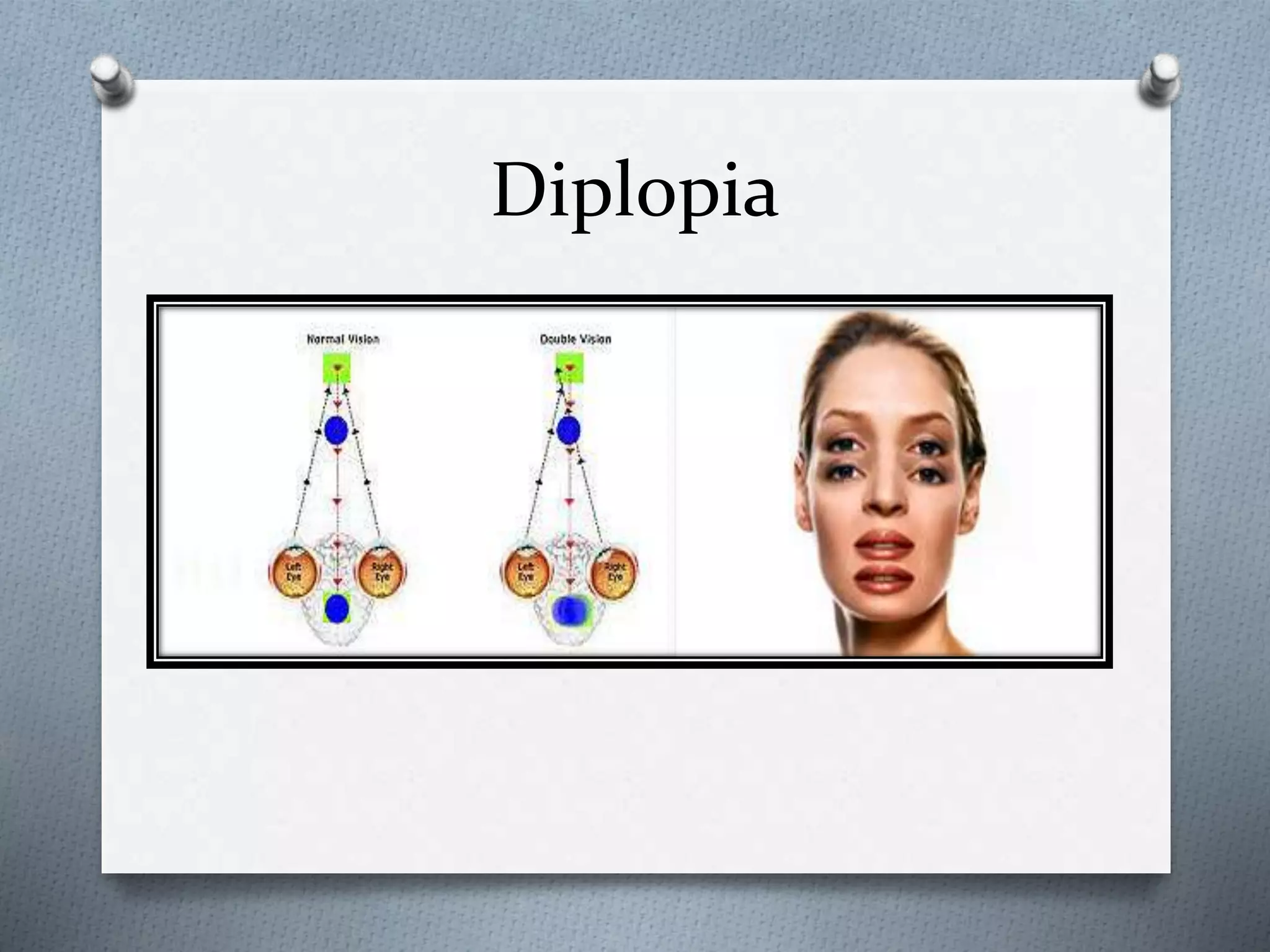 Diplopia by yugandhar tummala | PPTX