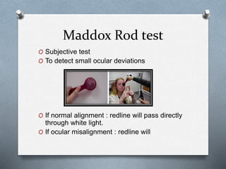 Diplopia by yugandhar tummala | PPTX