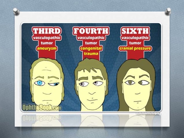 Diplopia by yugandhar tummala | PPTX | Eye and Vision Conditions ...