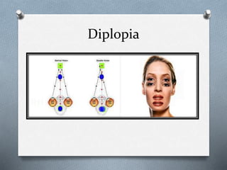 Diplopia by yugandhar tummala | PPTX