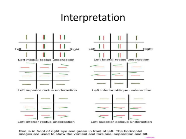 Diplopia charting | PPTX | Eye and Vision Conditions | Diseases and ...