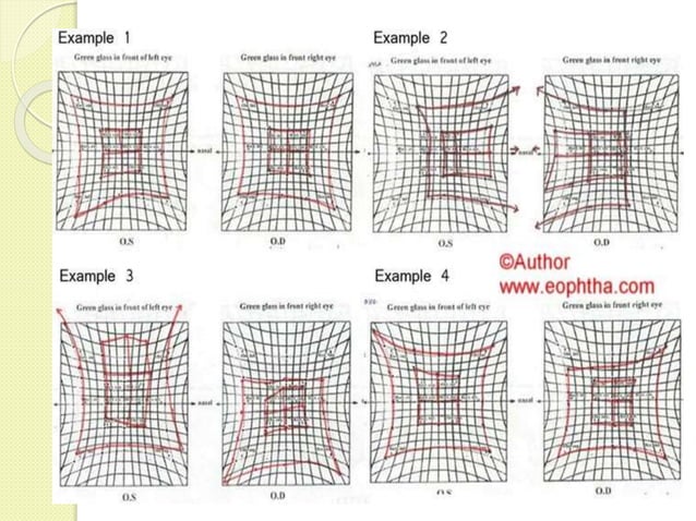 Diplopia charting | PPTX | Eye and Vision Conditions | Diseases and ...