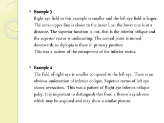 Diplopia charting | PPTX