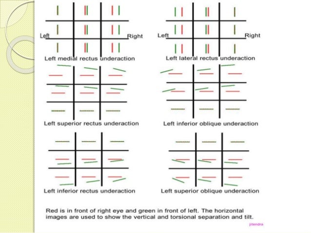 Diplopia charting