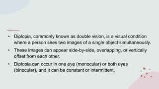 diplopia charting.ppt diplopia charting | PPTX
