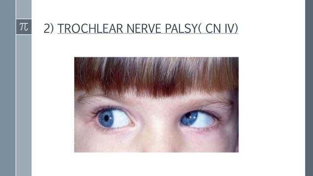 Diplopia charting | PPTX | Eye and Vision Conditions | Diseases and ...