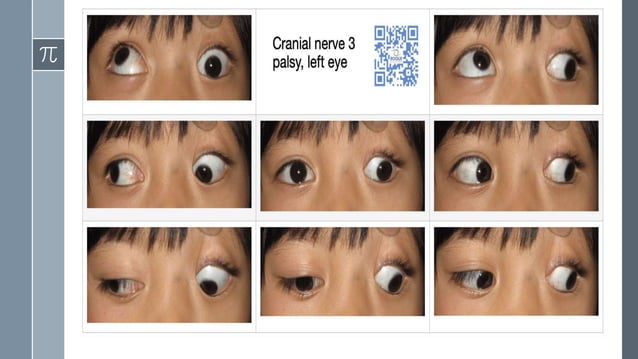 Diplopia charting | PPTX | Eye and Vision Conditions | Diseases and ...