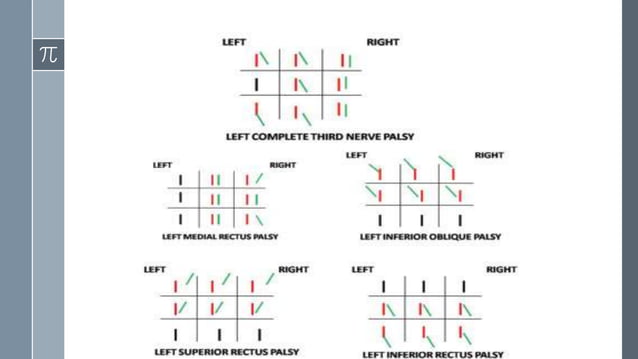 Diplopia charting | PPTX | Eye and Vision Conditions | Diseases and ...