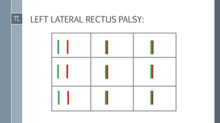 Diplopia charting | PPT