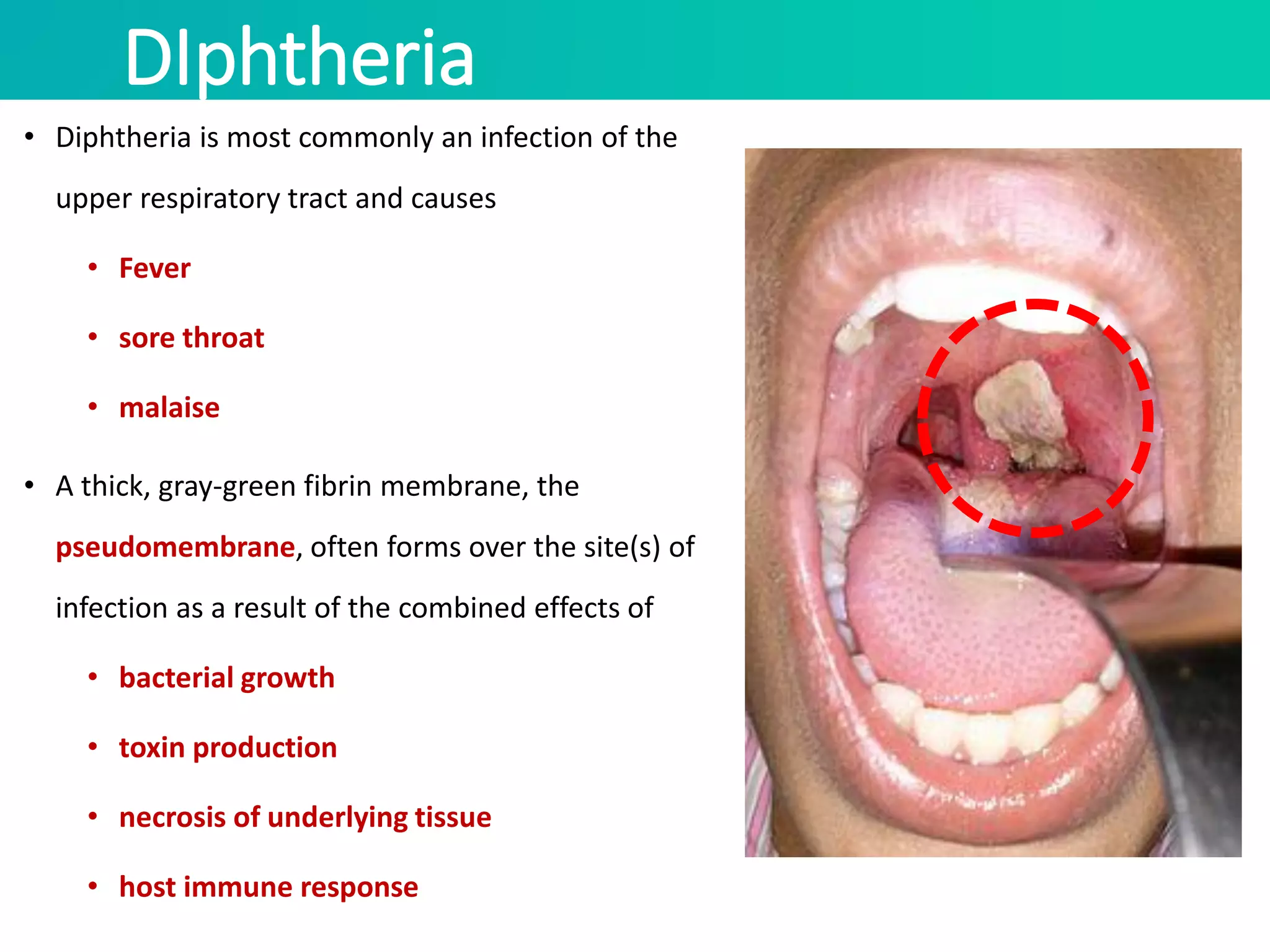 Diptheria | PDF