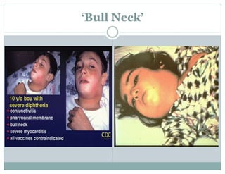 DIPTHERIA.ppt
