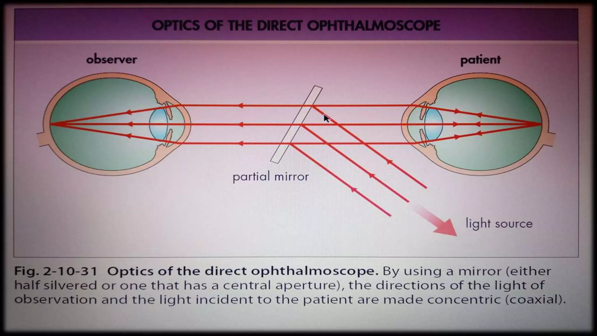Direct ophthalmoscopy | PPTX