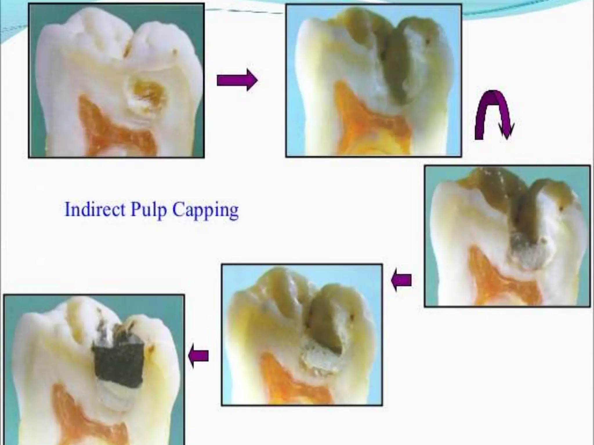Direct and indirect pulp capping | PPTX