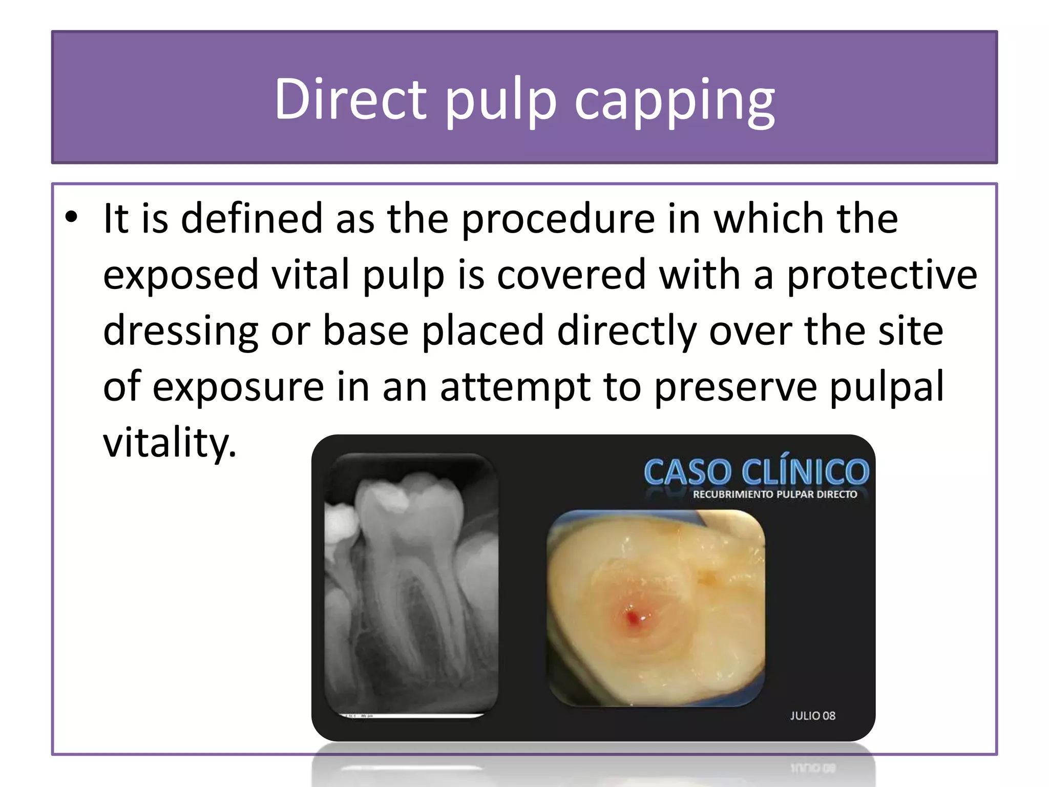Direct and indirect pulp capping | PPTX