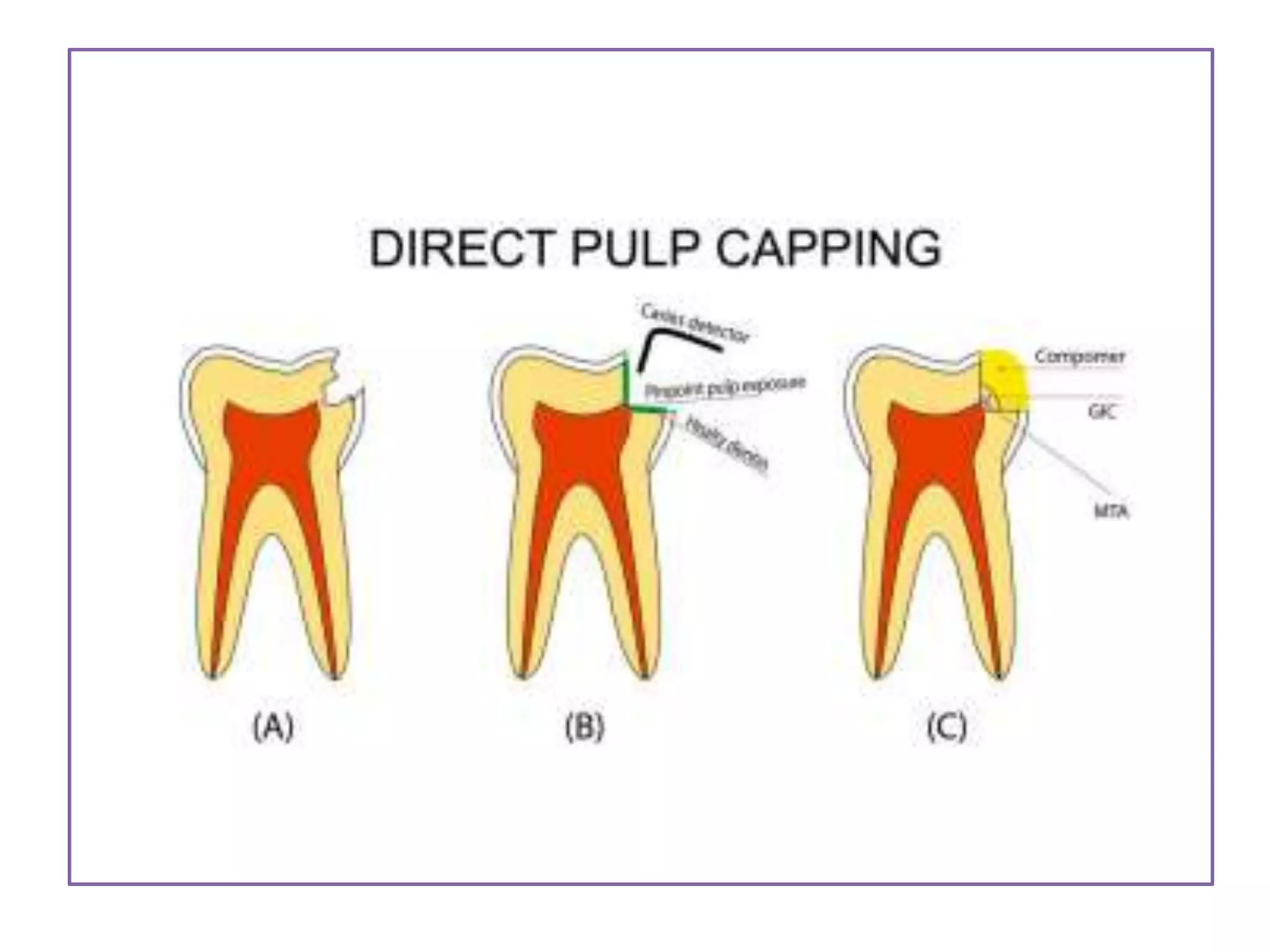 Direct and indirect pulp capping | PPTX