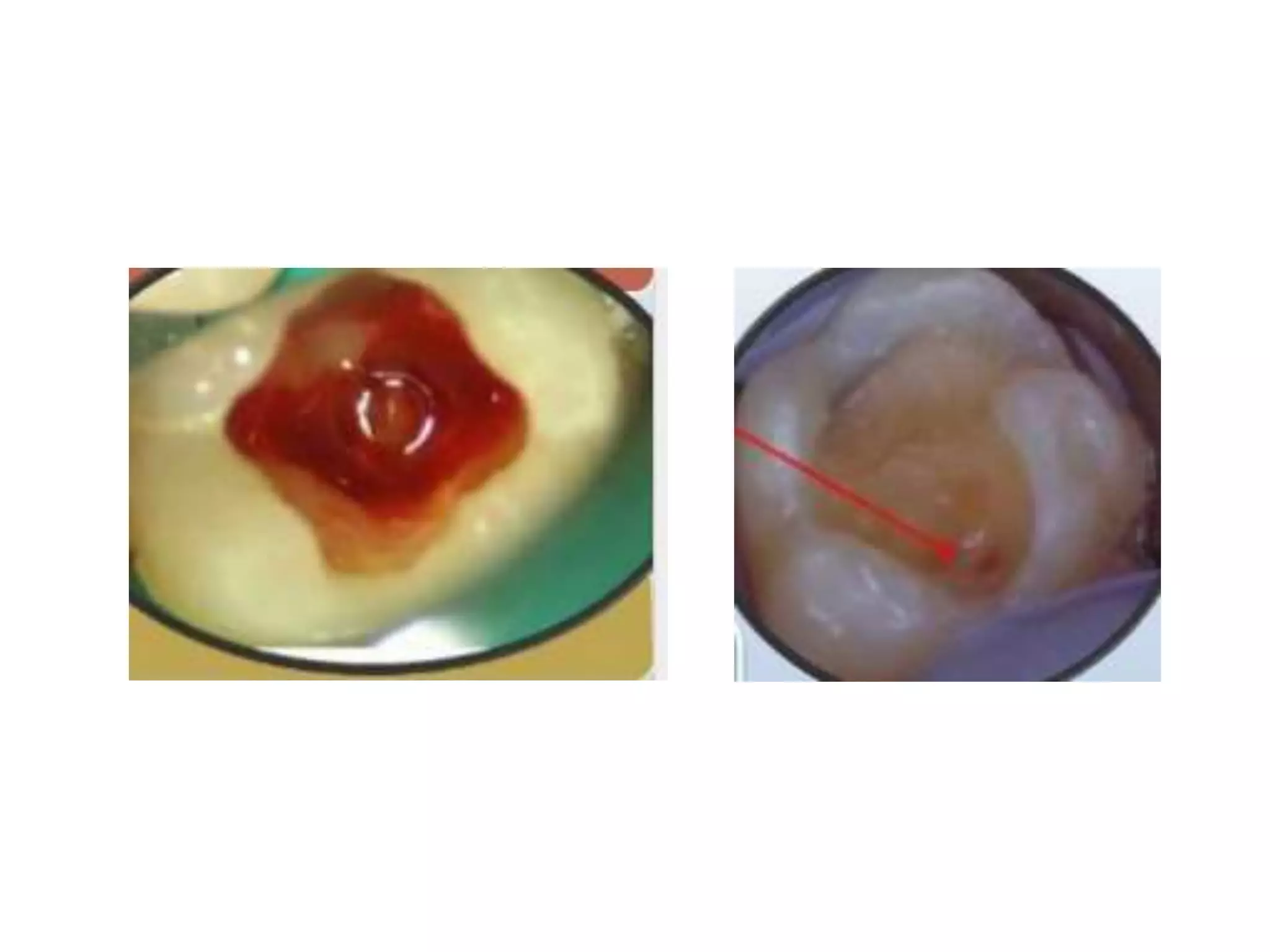 Direct and indirect pulp capping | PPTX