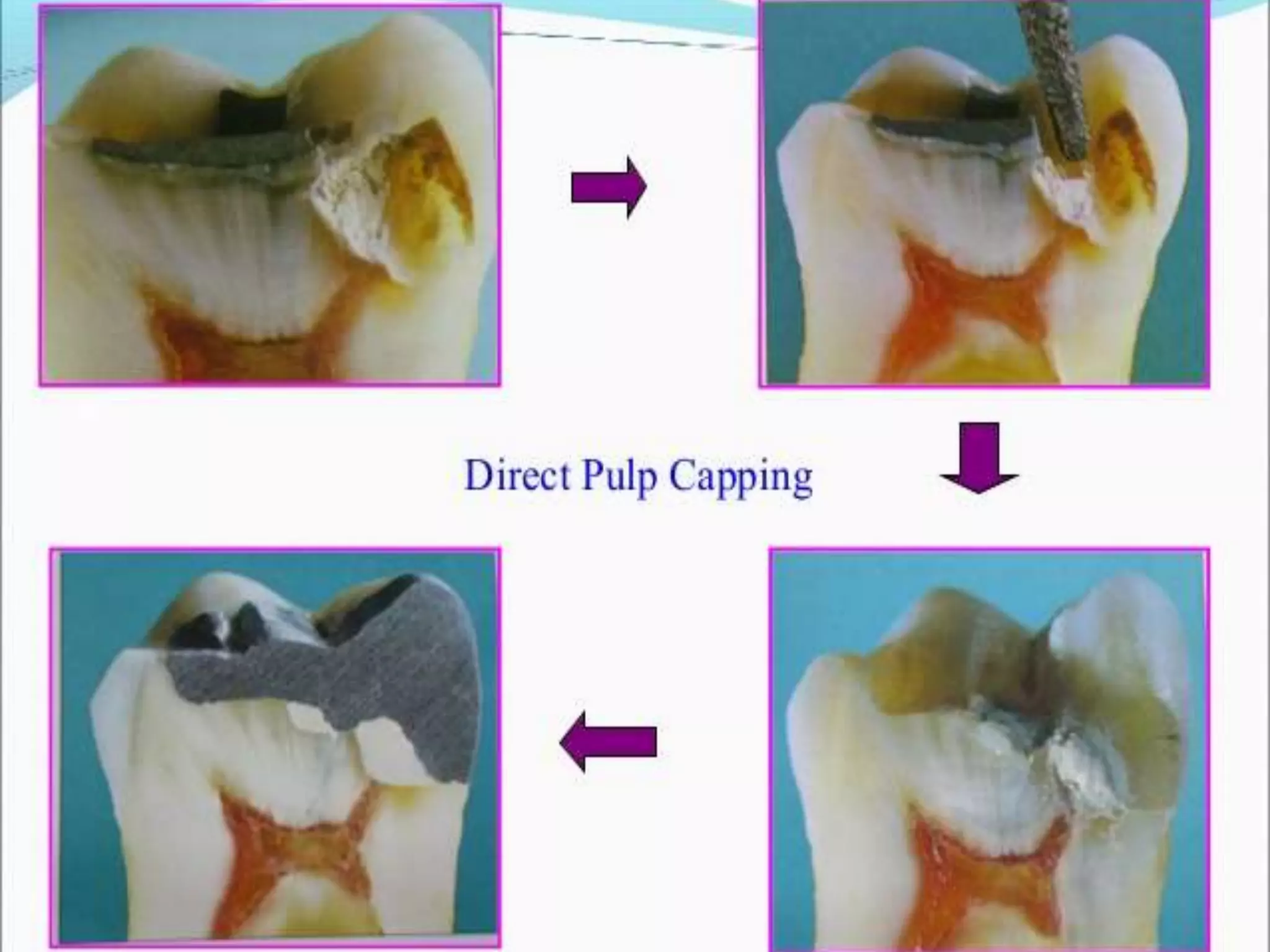 Direct and indirect pulp capping | PPTX