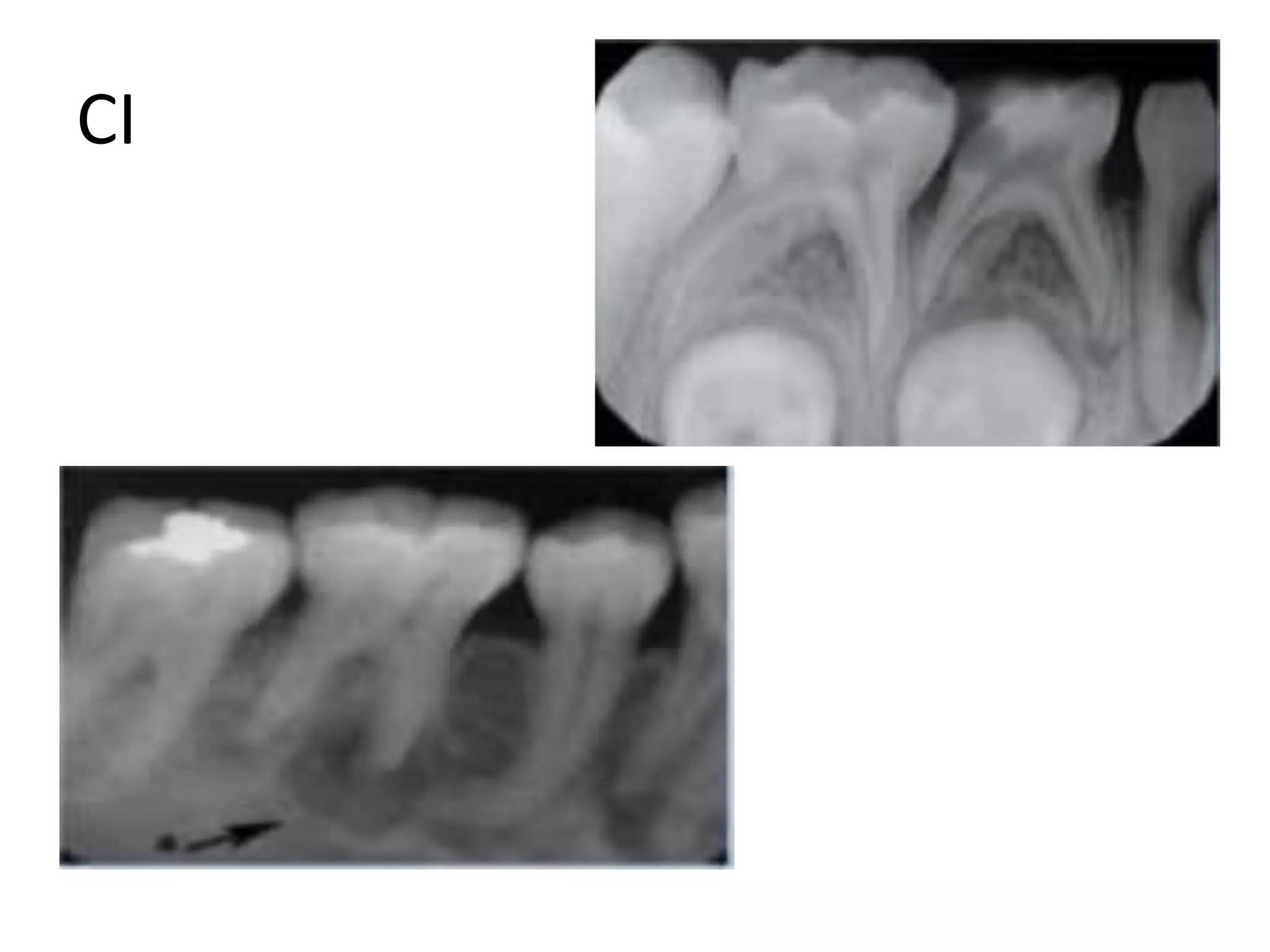 Direct and indirect pulp capping | PPTX | Dental Health | Diseases and ...