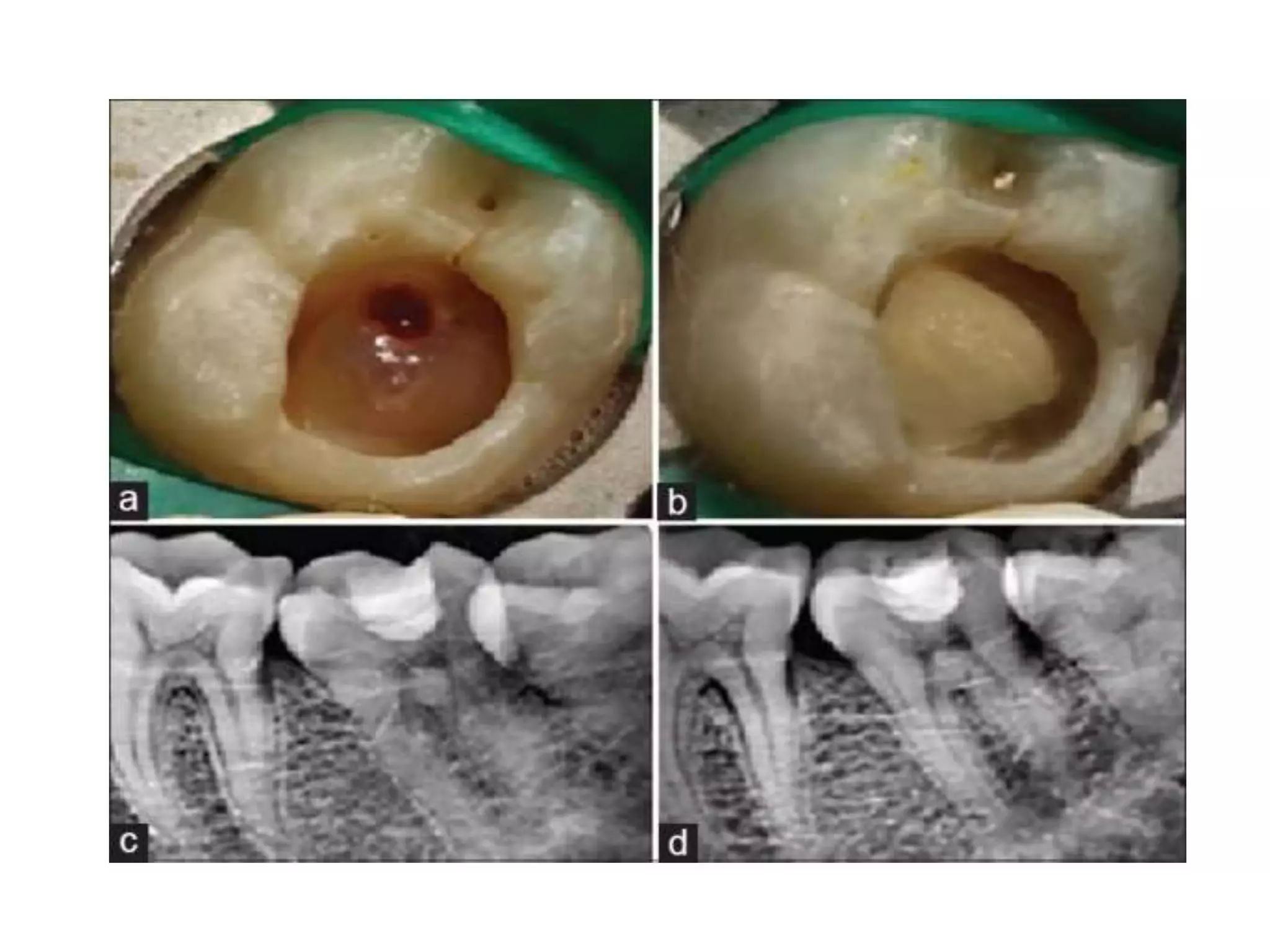 Direct and indirect pulp capping | PPTX
