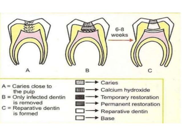 Direct and indirect pulp capping | PPTX | Dental Health | Diseases and ...