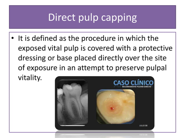 Direct and indirect pulp capping | PPT