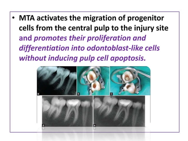 Direct and indirect pulp capping | PPTX | Dental Health | Diseases and ...