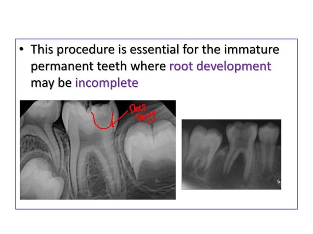 Direct and indirect pulp capping | PPTX | Dental Health | Diseases and ...
