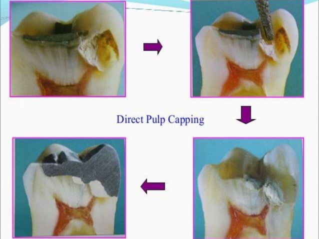 Direct and indirect pulp capping | PPT