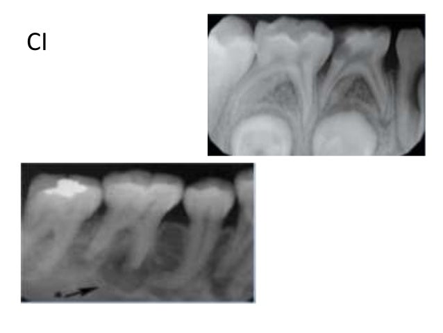 Direct and indirect pulp capping