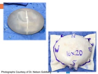 Direct to Implant Prepectoral Breast Reconstruction | PPTX