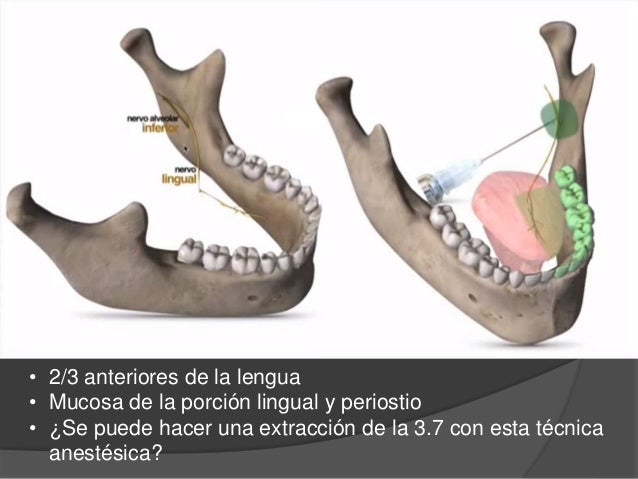 Tècnica Anestesica Directa al dentario inferior