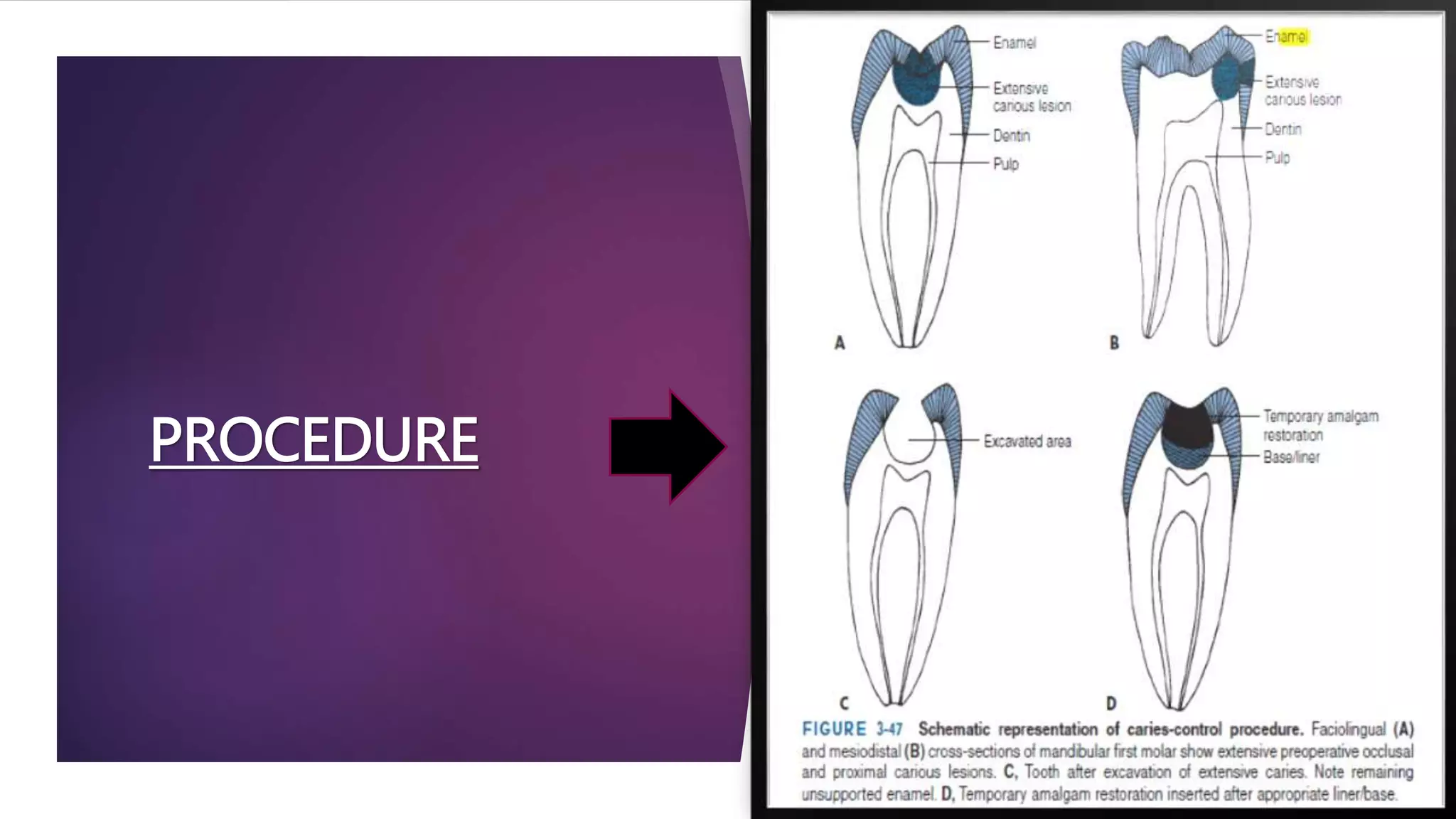 Direct and Indirect pulp capping | PPTX