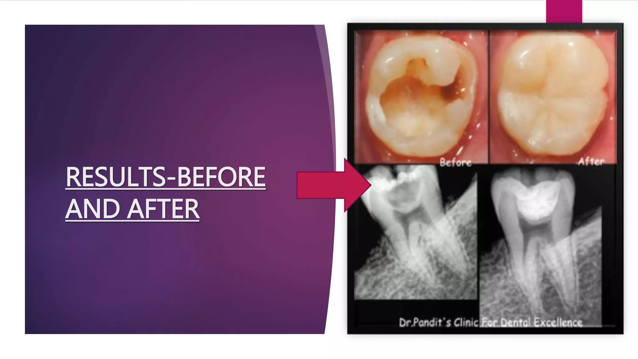 Direct and Indirect pulp capping | PPTX