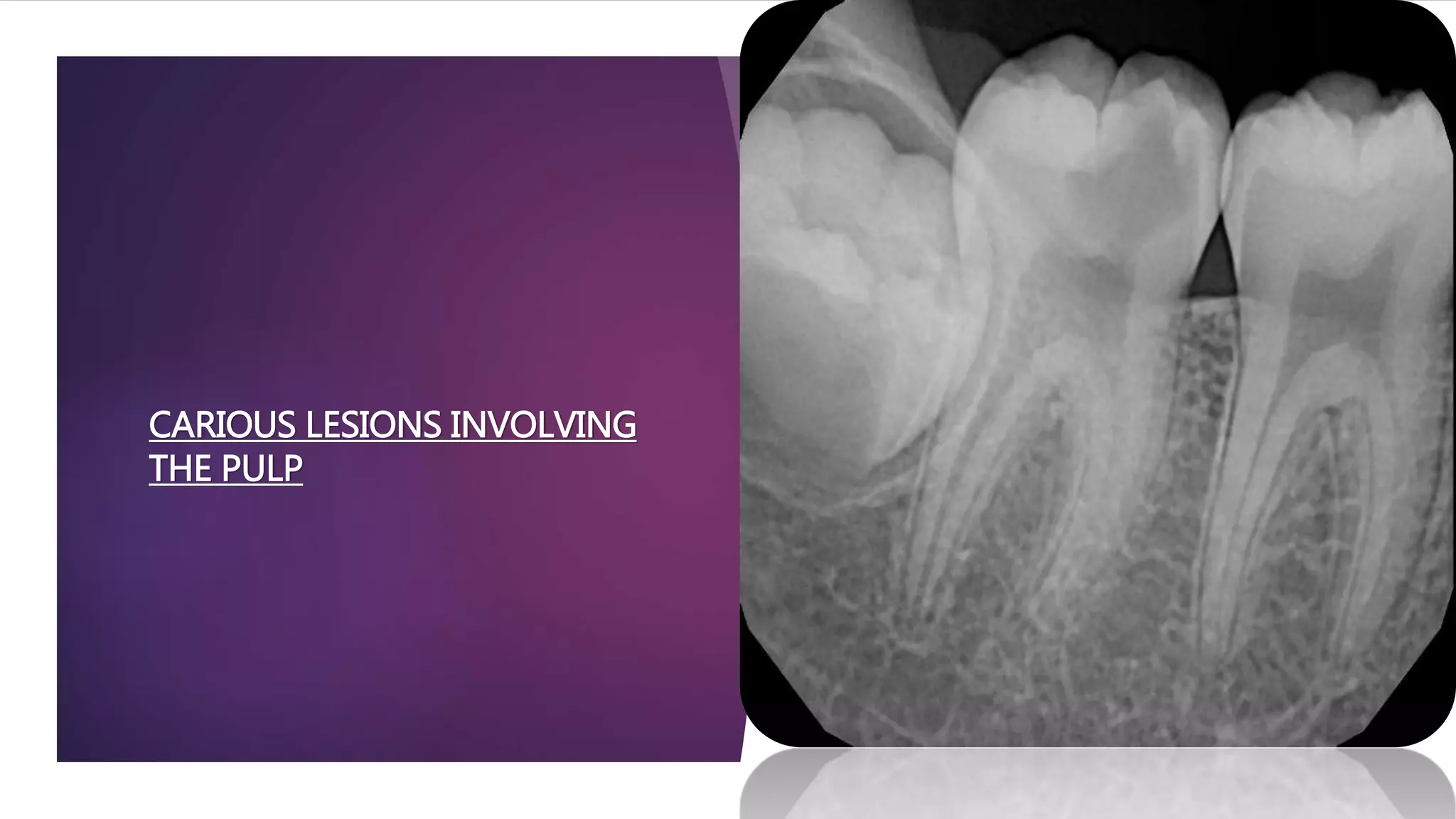 Direct and Indirect pulp capping | PPTX